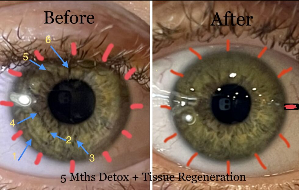 Iris Analysis - Alka-clean Detox and Tissue Regeneration